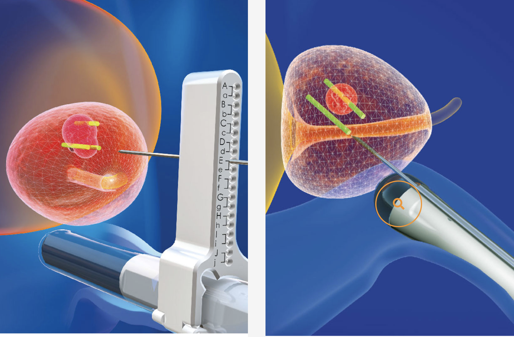 Biopsia de Fusión - Urología en A Coruña